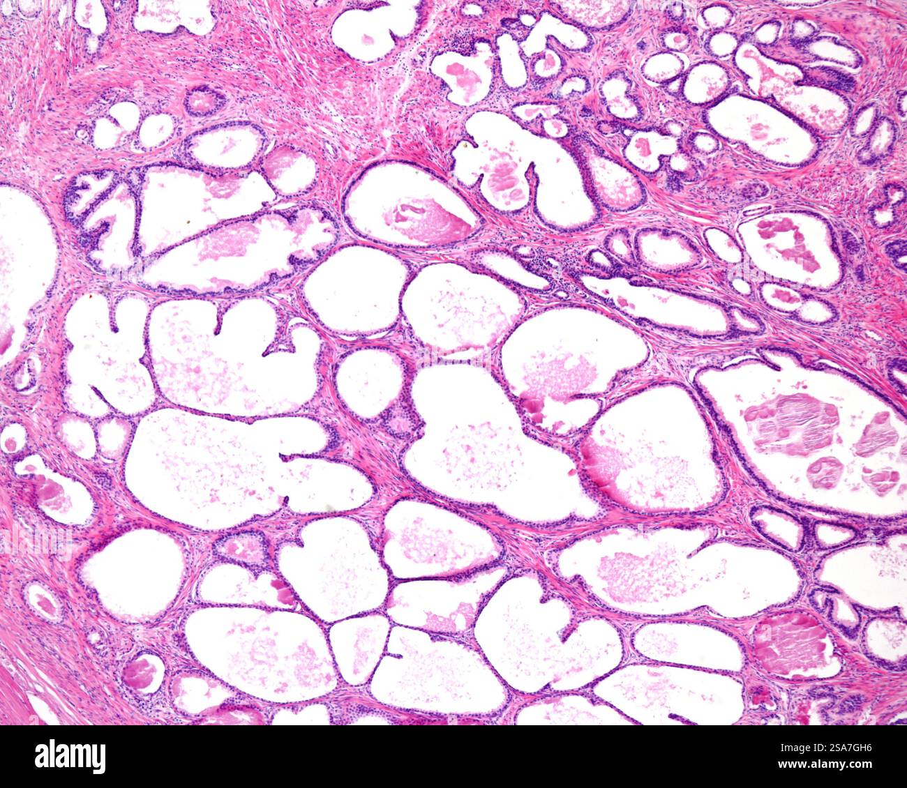 Light micrograph showing a human prostate with benign prostatic ...