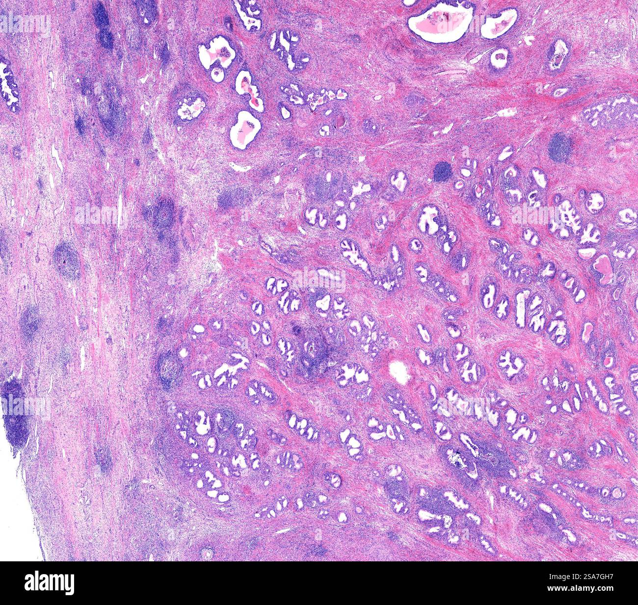 Light micrograph of a human prostate showing a severe chronic ...