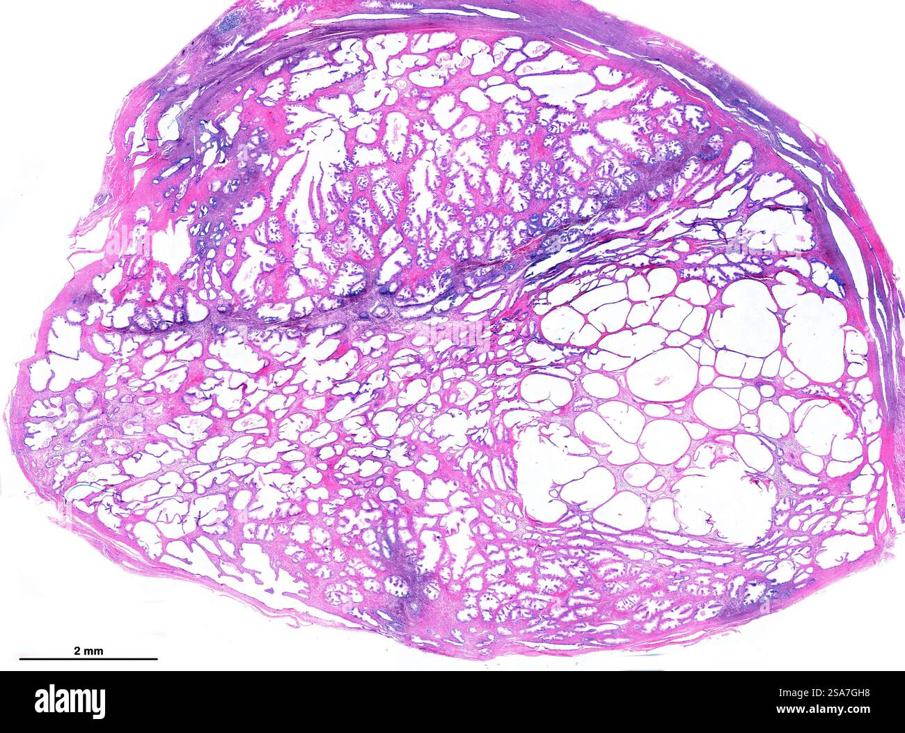 Light micrograph showing a large (about 1.5 cm) hyperplastic nodule in ...