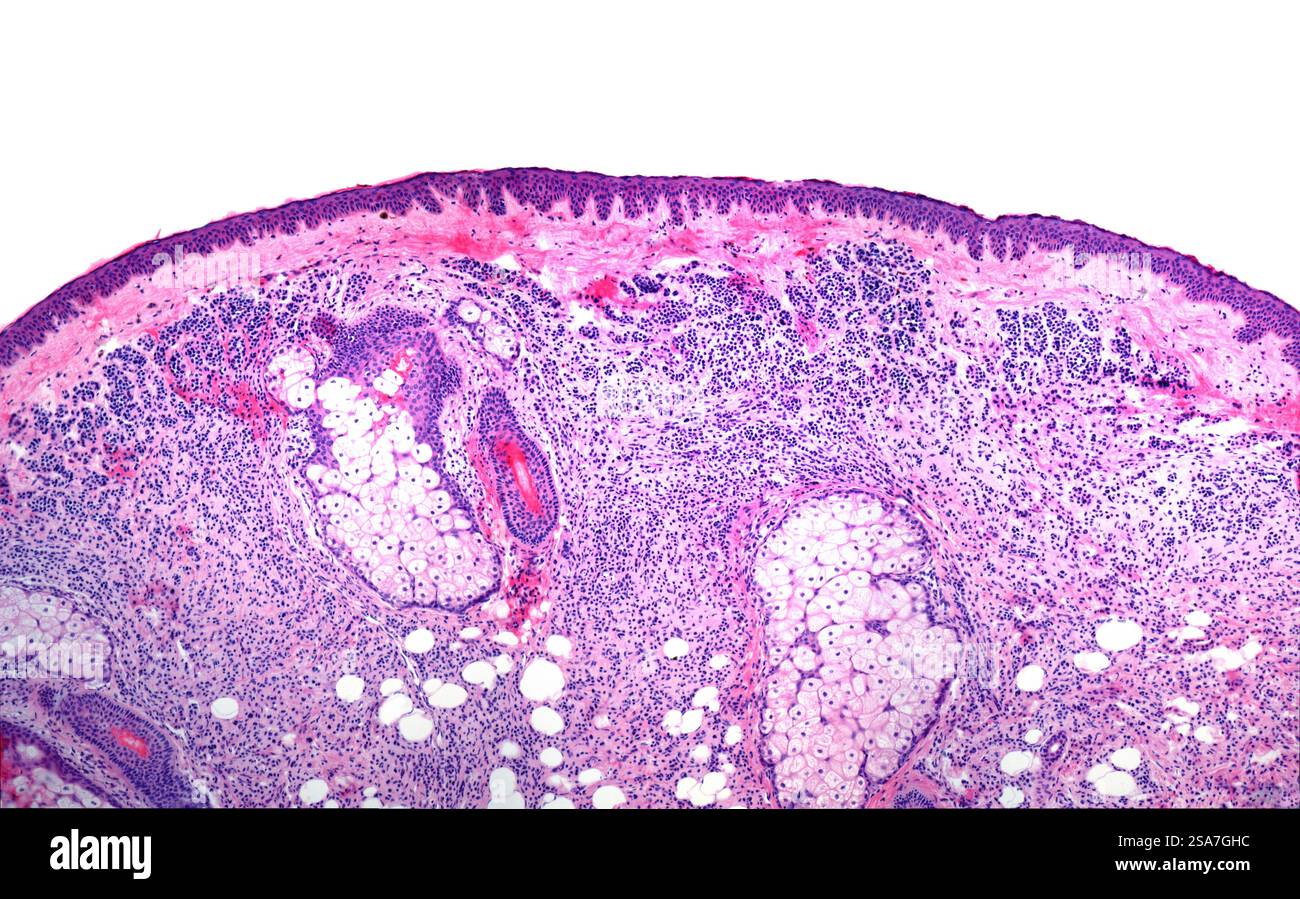 Light micrograph showing an intradermal naevus, a benign proliferation ...