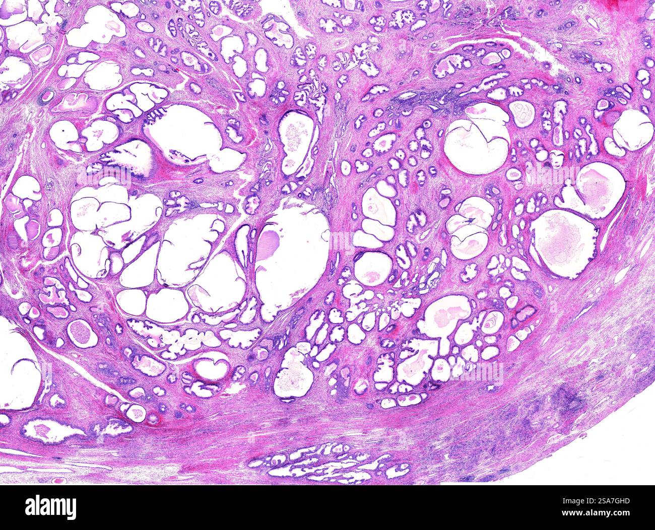 Light micrograph of prostate tissue in a case of benign (non-cancerous ...