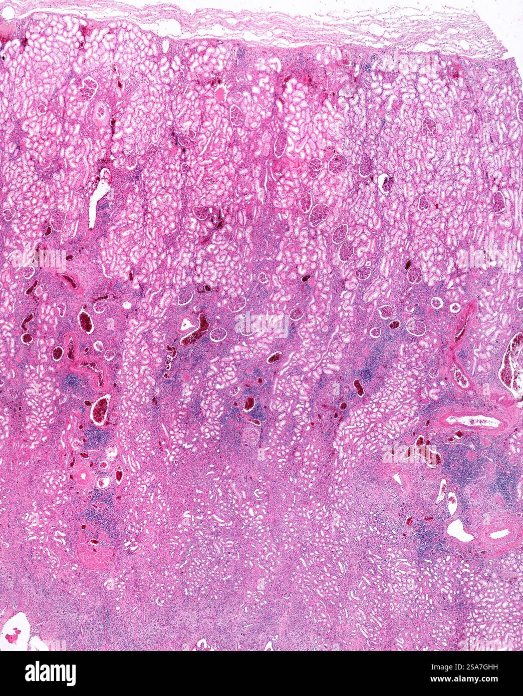 Light micrograph showing a kidney affected by chronic pyelonephritis. Large clusters of chronic ...