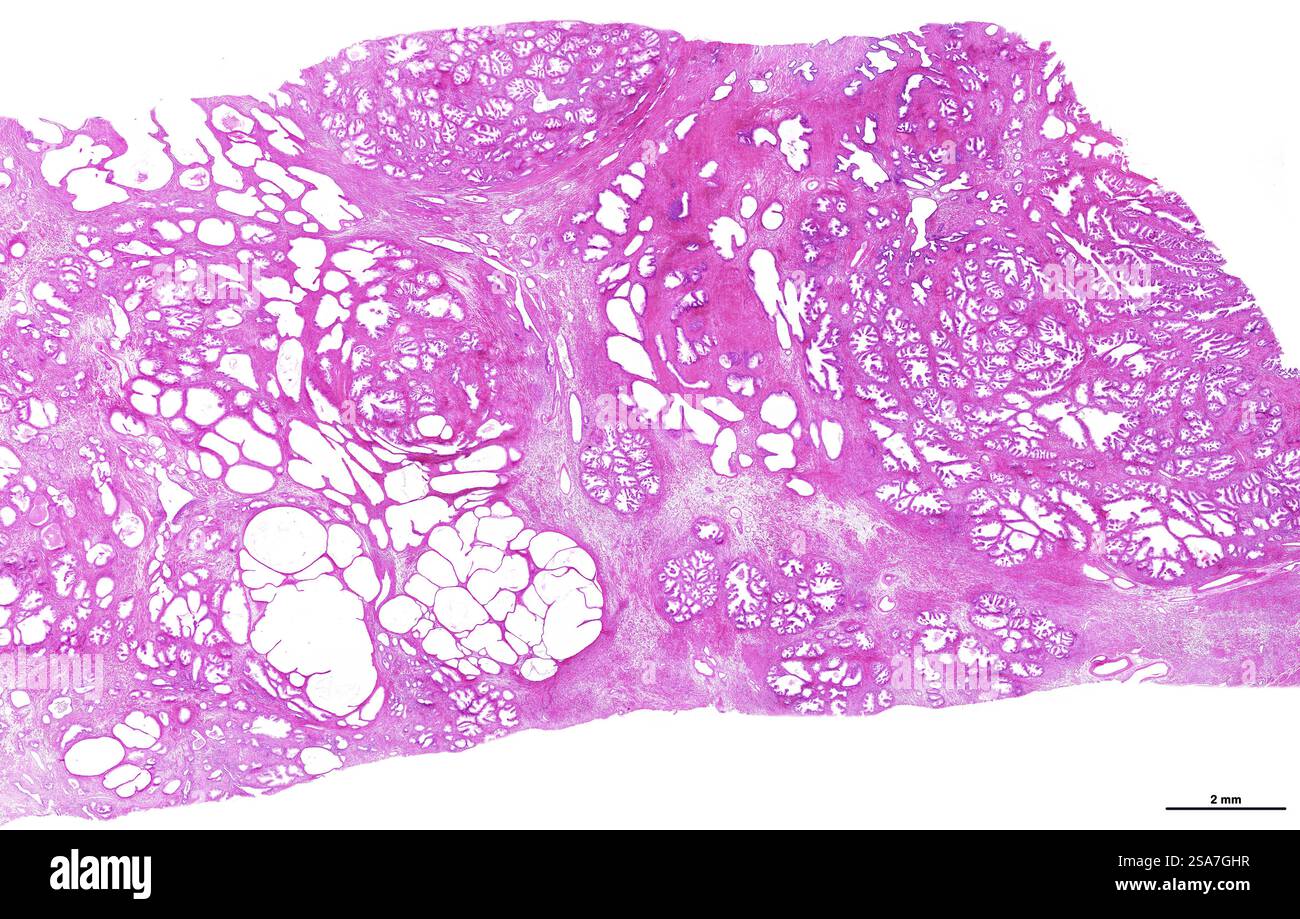 Light micrograph of a large surgical piece taken from a case of benign ...