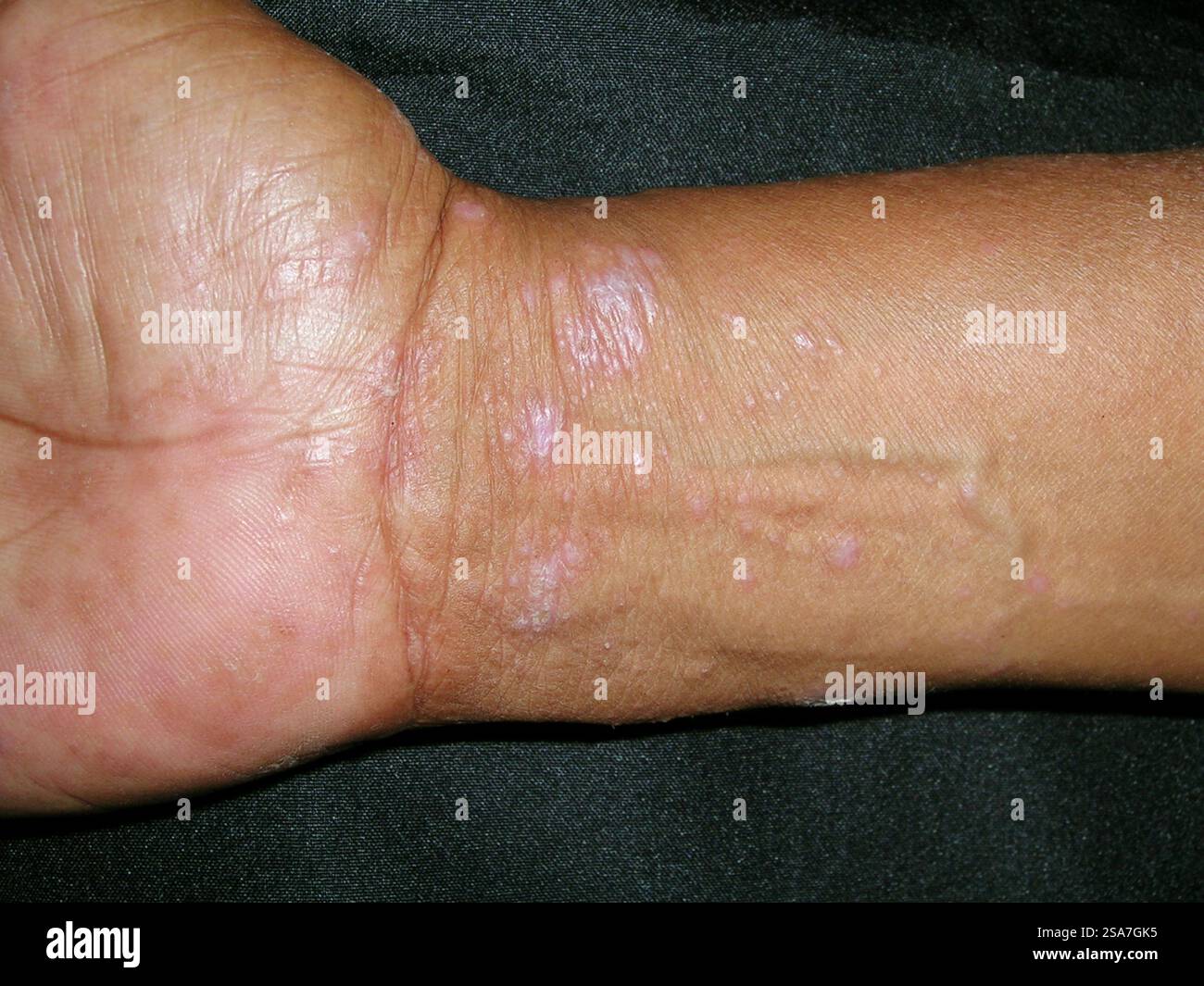 Lichen planus on a female African-American patient's wrist. Lichen ...