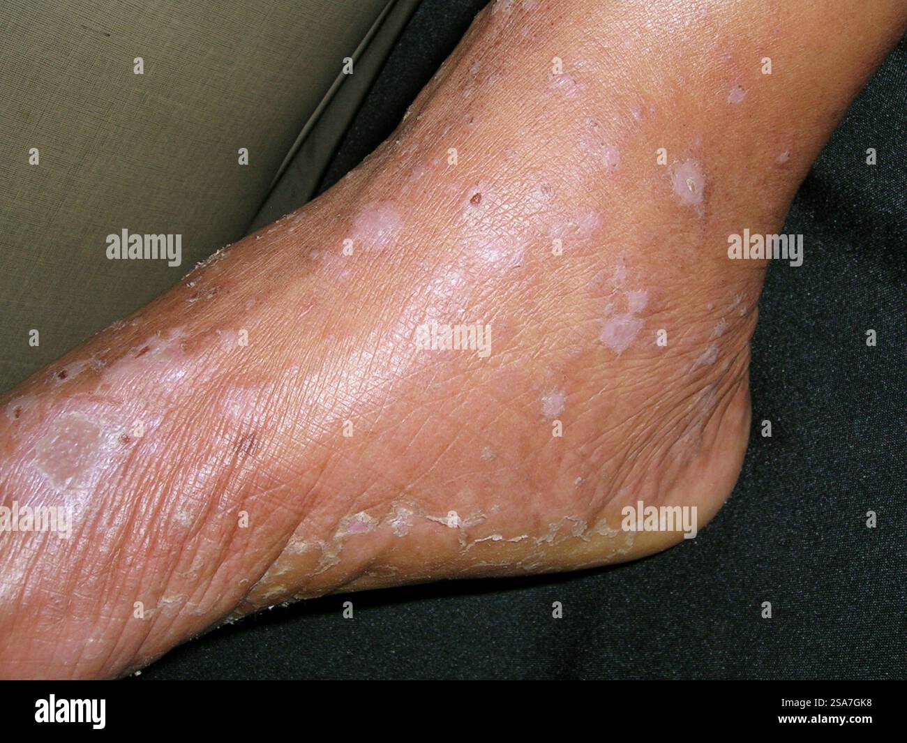 Lichen planus on a female African-American patient's foot. Lichen ...