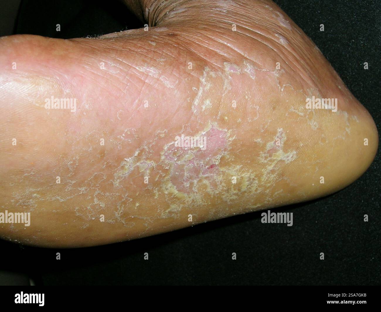 Lichen planus on a female African-American patient's foot. Lichen ...