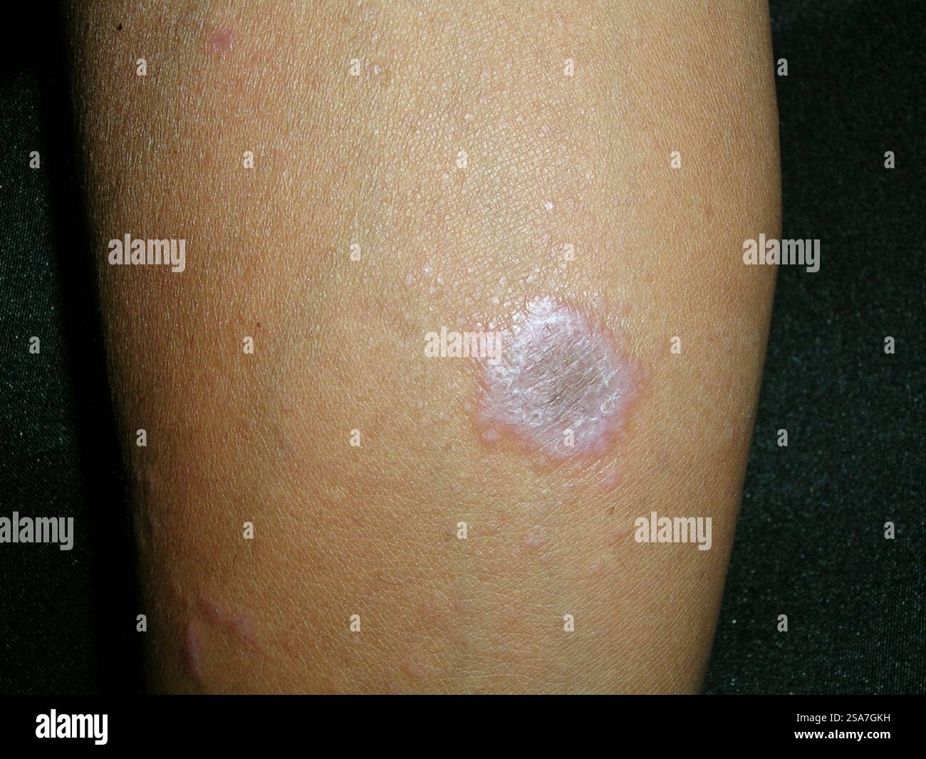 Lichen planus on a female African-American patient's skin. Lichen ...