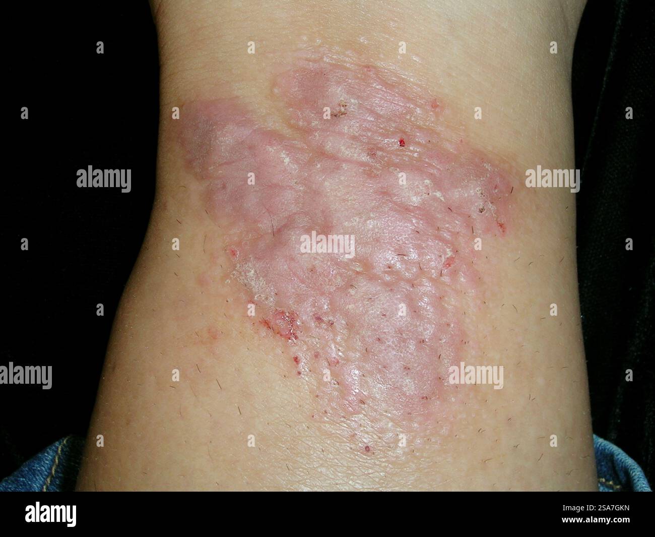 Wrist of a patient with lichen simplex chronicus (neurodermatitis). The ...