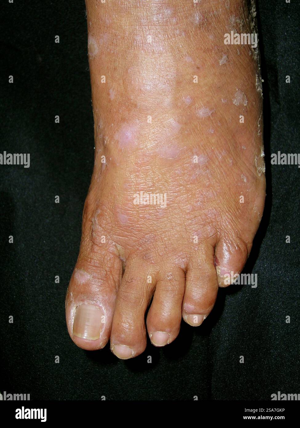 Lichen planus on a female African-American patient's foot. Lichen ...