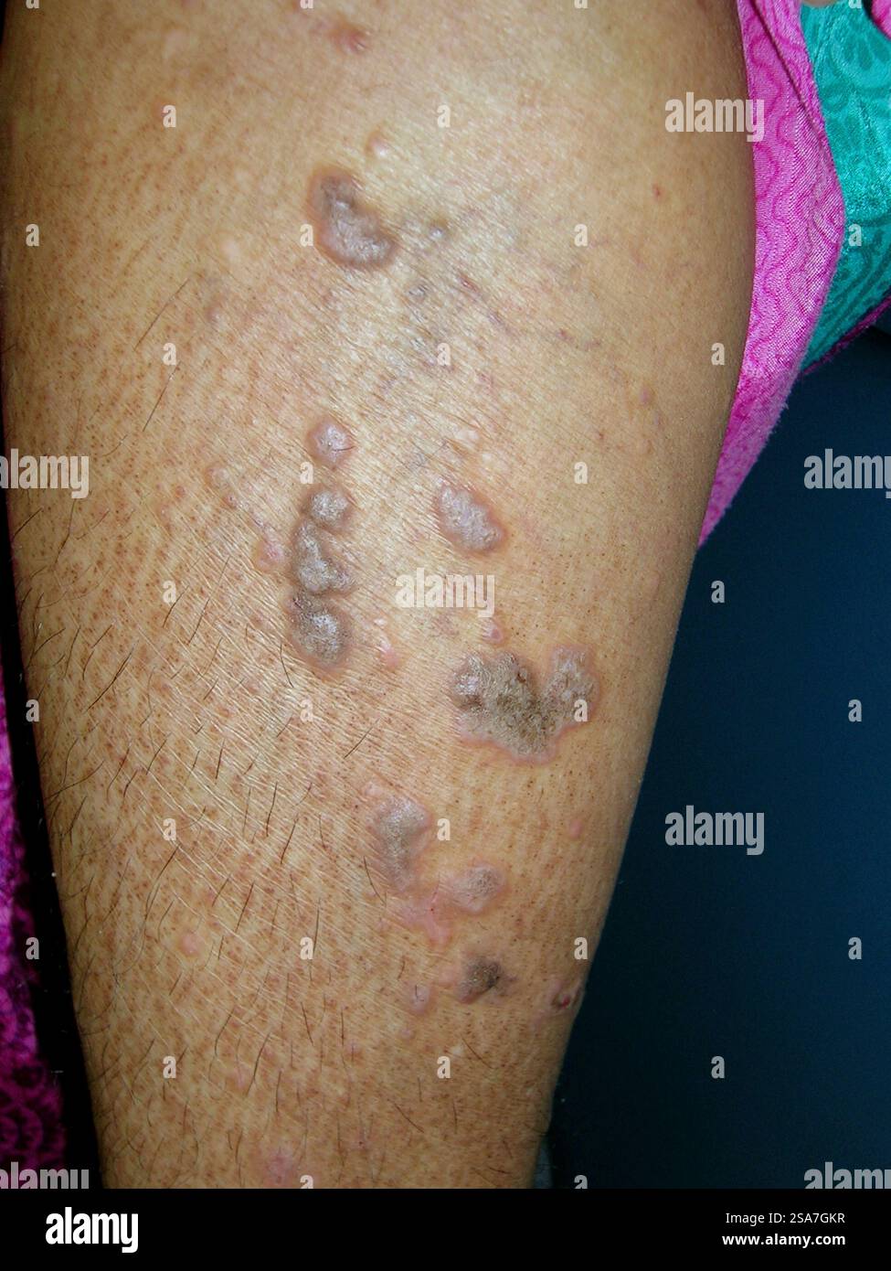 Lichen planus on a patient's skin. Lichen planus is an inflammatory ...