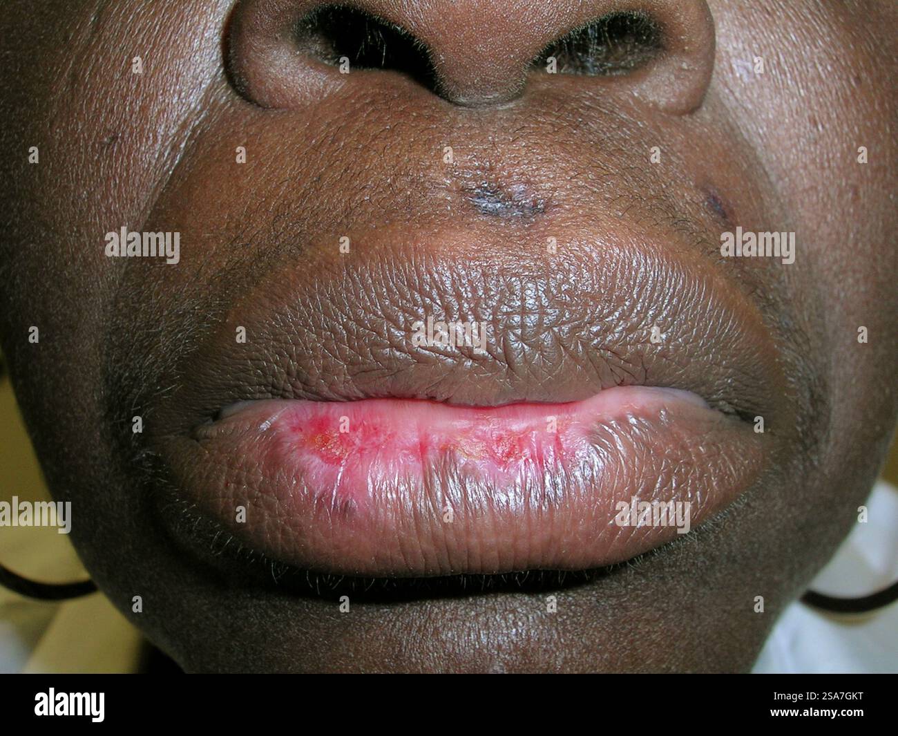 Inflamed lips of a patient with lupus erythematosus (LE). LE is an ...