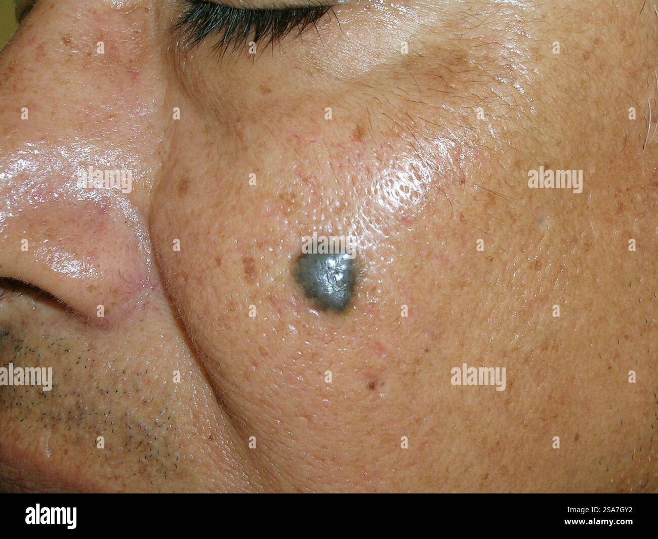 Pigmented basal cell carcinoma (BCC), or rodent ulcer, on a patient's ...