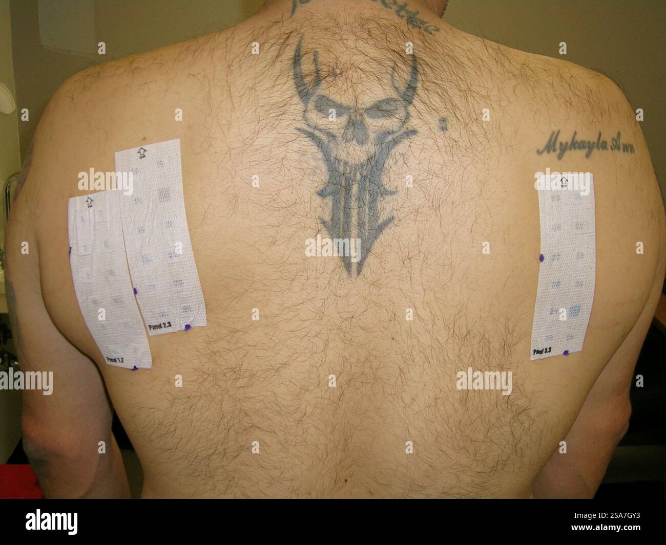 Editorial use only Allergy test strips on a male patient's back. On ...
