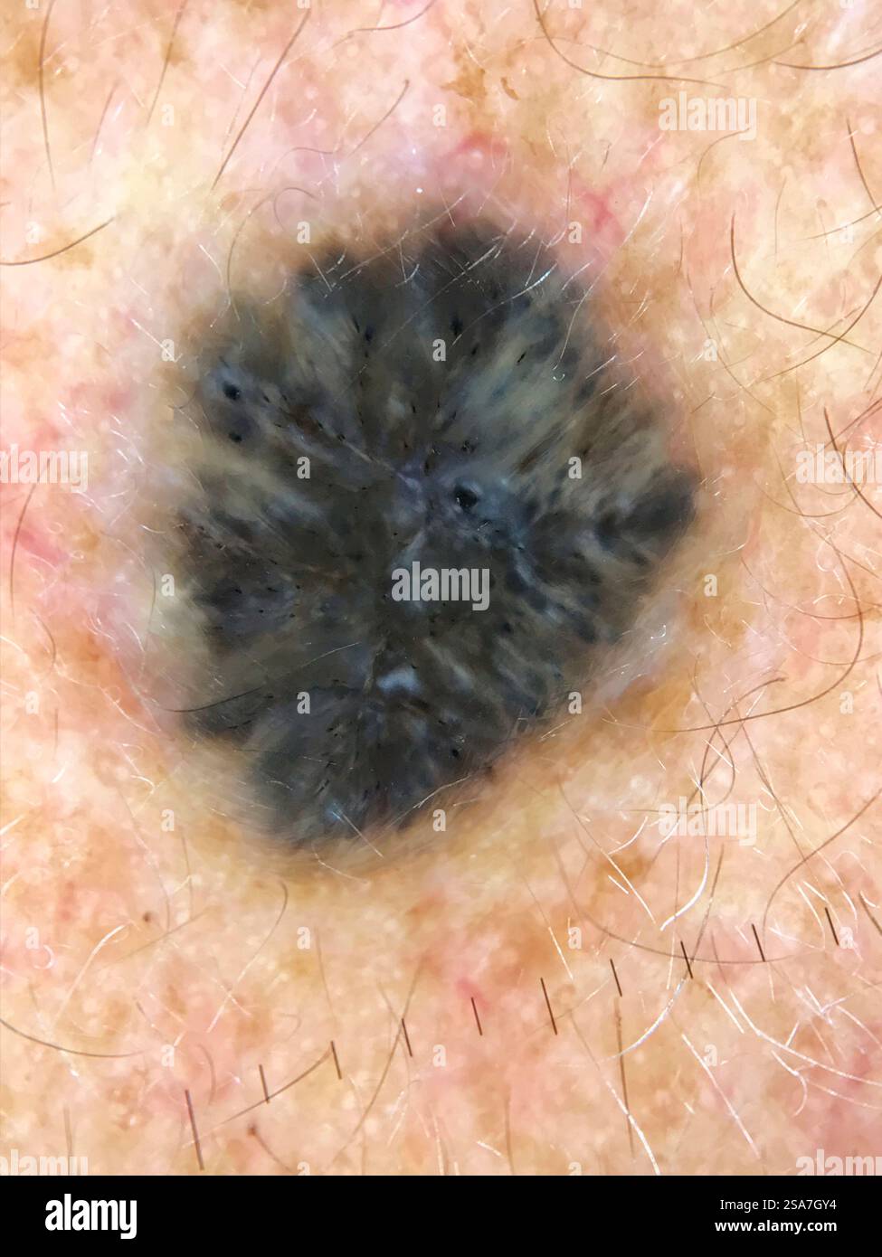 Dermatoscope image of a pigmented basal cell carcinoma (BCC), or rodent ...