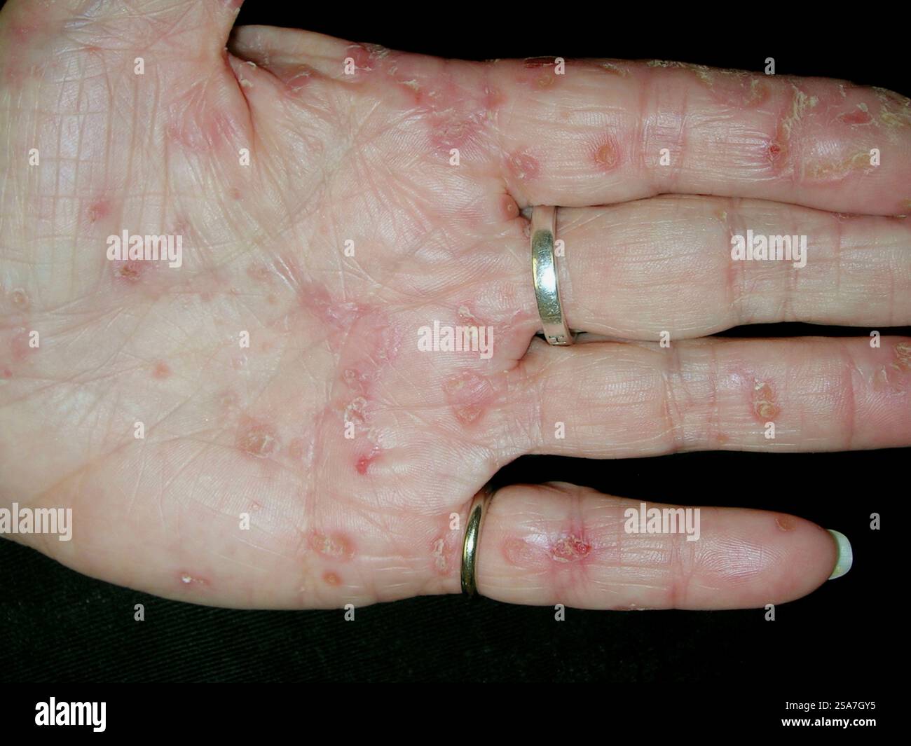 Pityriasis lichenoides chronica lesions on a patient's hand. This ...