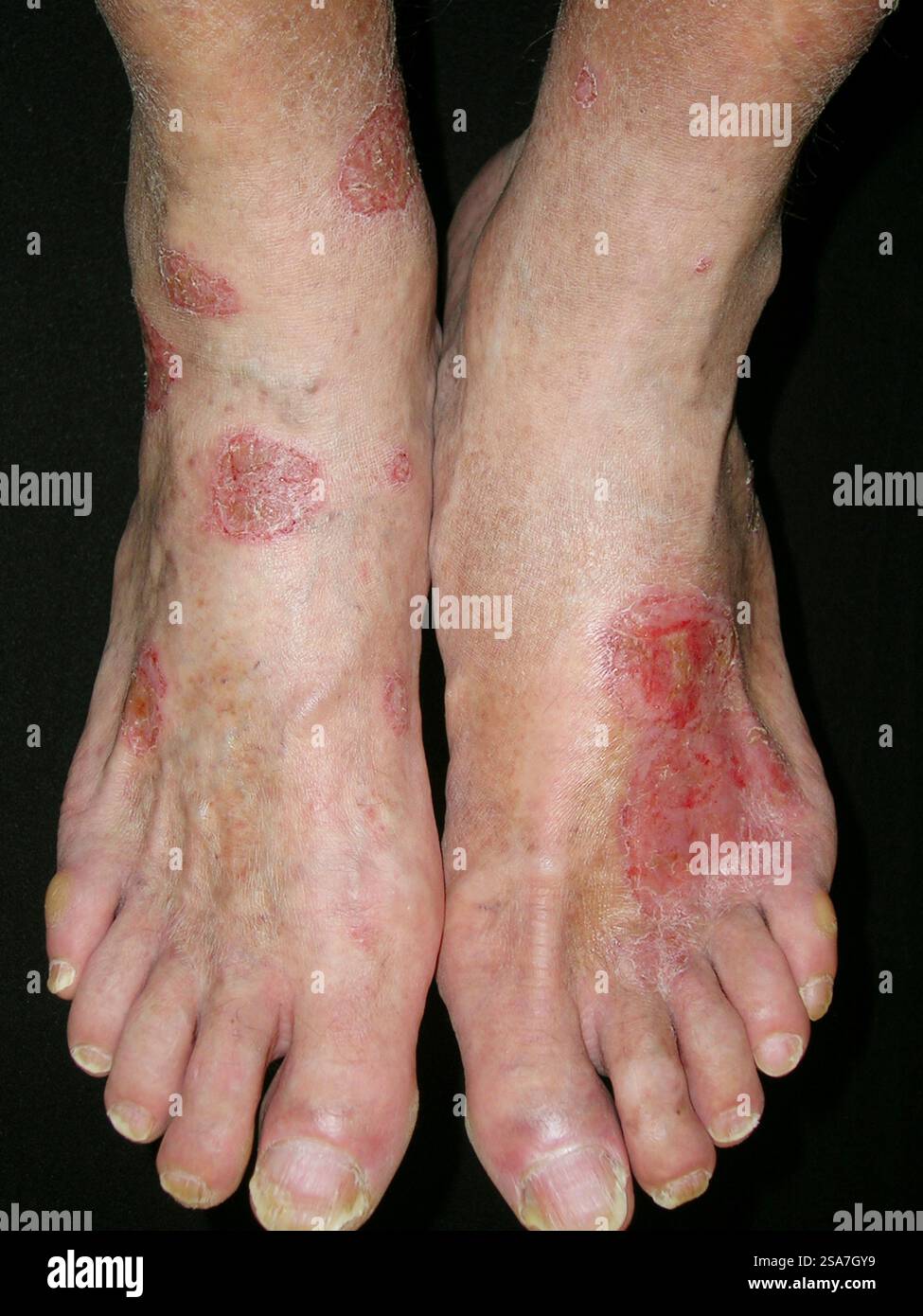 Nummular eczema on a patient's feet. Eczema is an inflammation of the ...