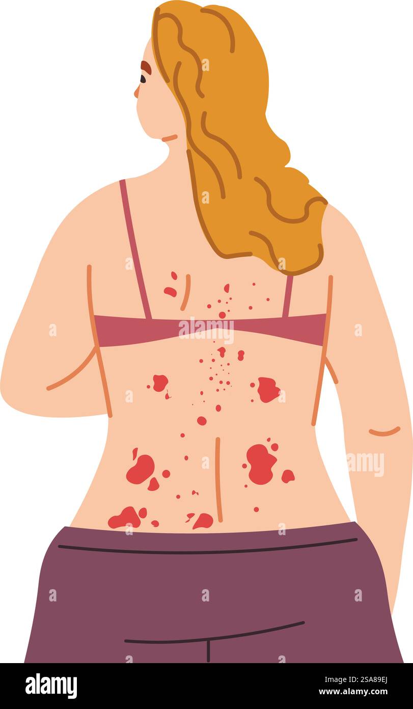 Illustration of a woman with a skin rash on her back. The style is ...