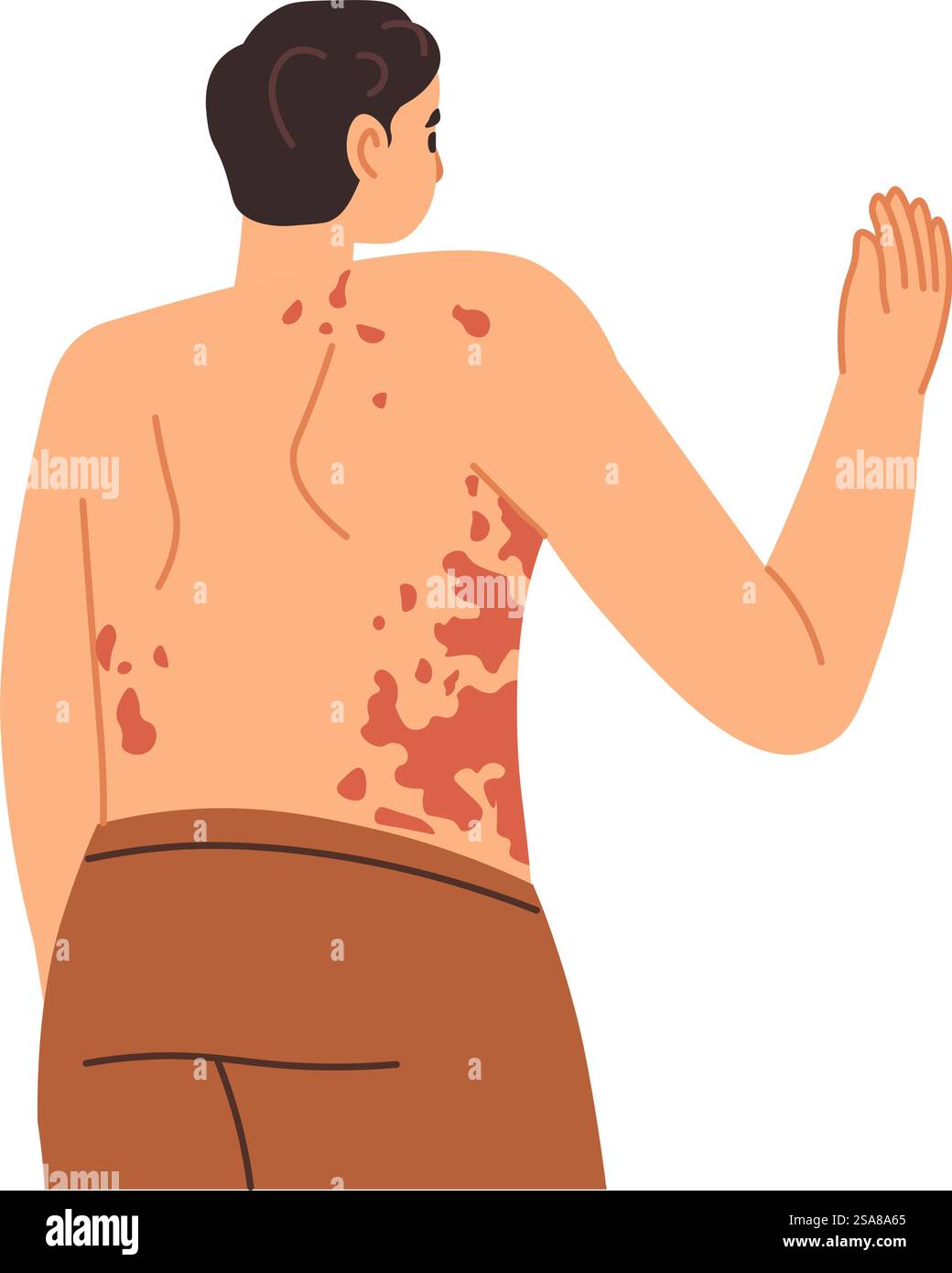 Illustration of a man with a skin rash on his back. The style is modern ...