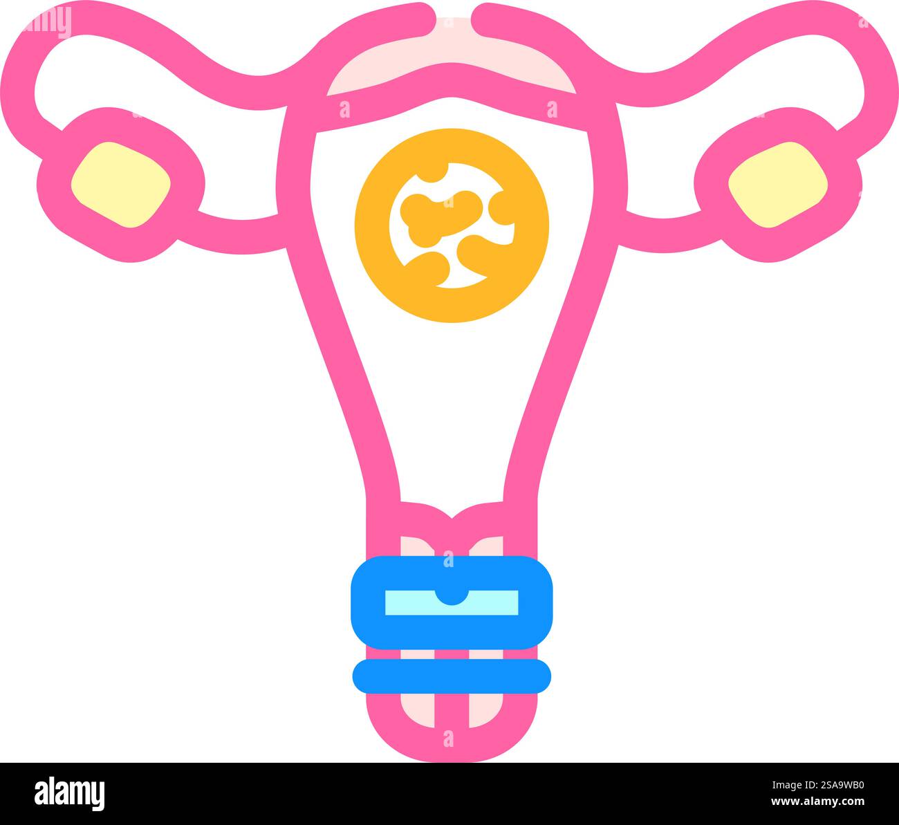 cervical cerclage surgery color icon vector. cervical cerclage surgery ...