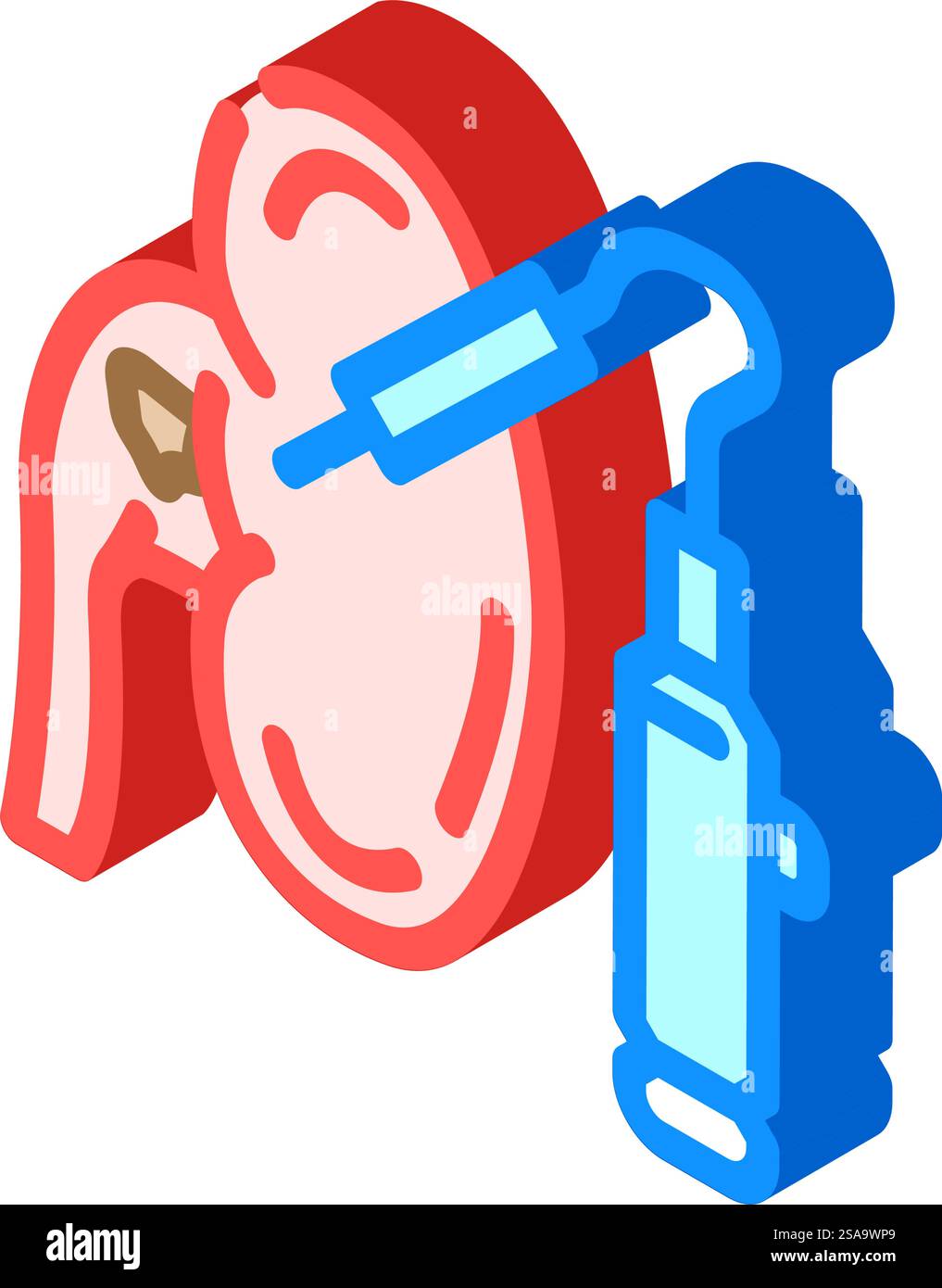 percutaneous nephrolithotomy surgery isometric icon vector ...