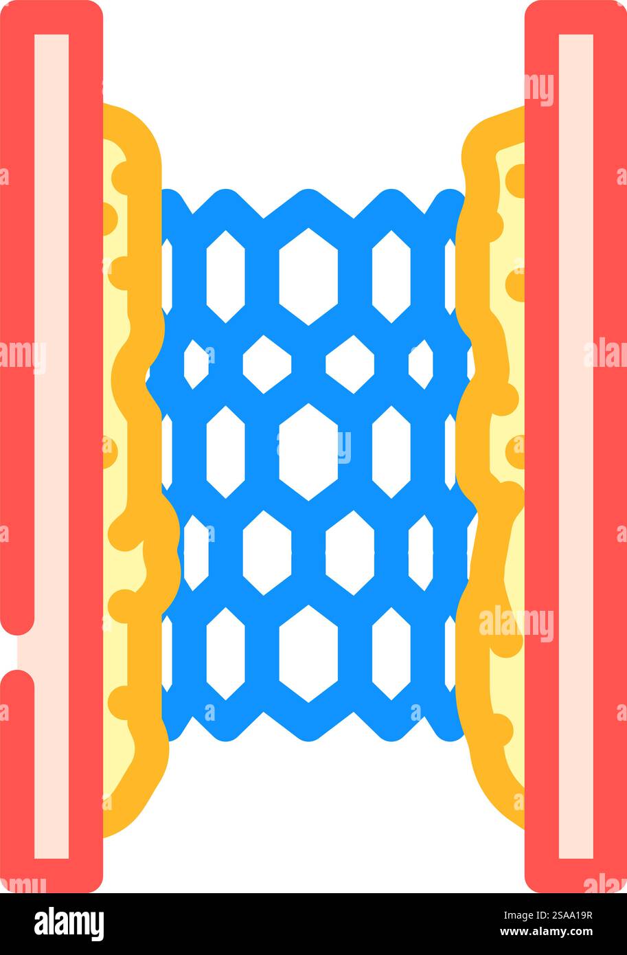 stent placement surgery color icon vector. stent placement surgery sign ...