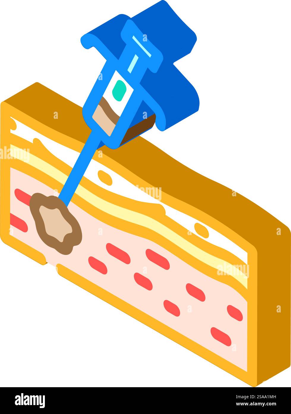 biopsy cancer treatment isometric icon vector. biopsy cancer treatment ...