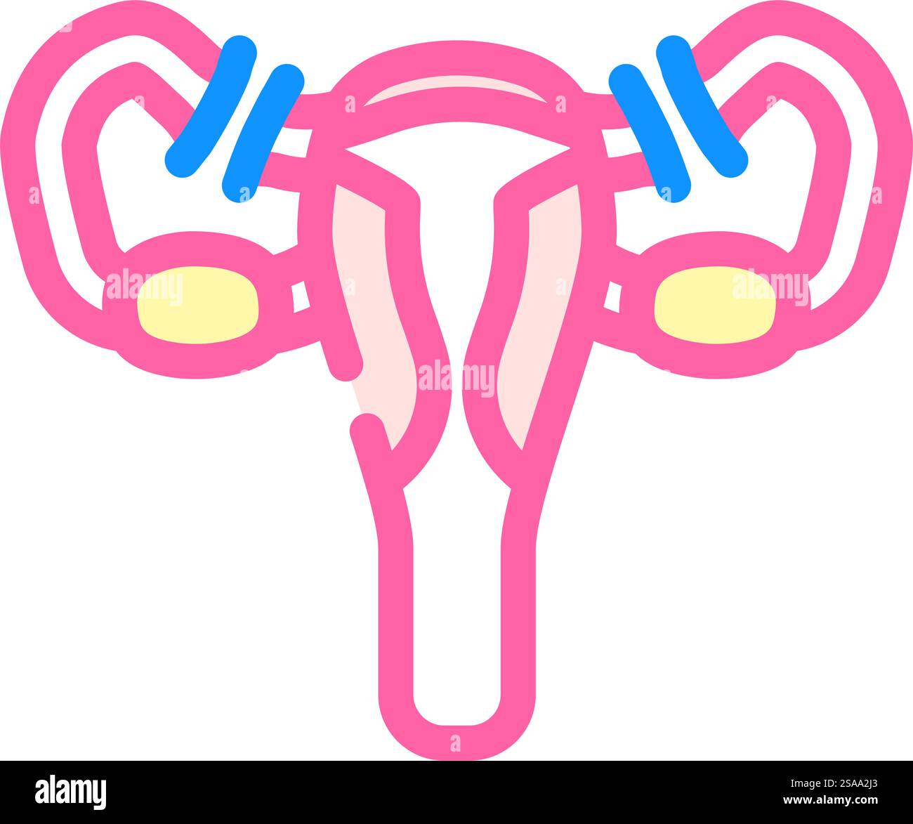 tubal ligation surgery color icon vector. tubal ligation surgery sign ...