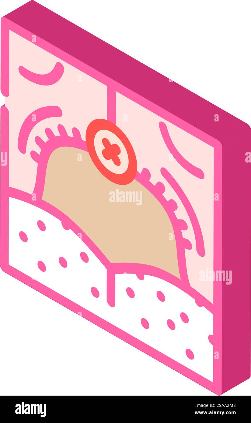 uvulopalatopharyngoplasty surgery isometric icon vector ...