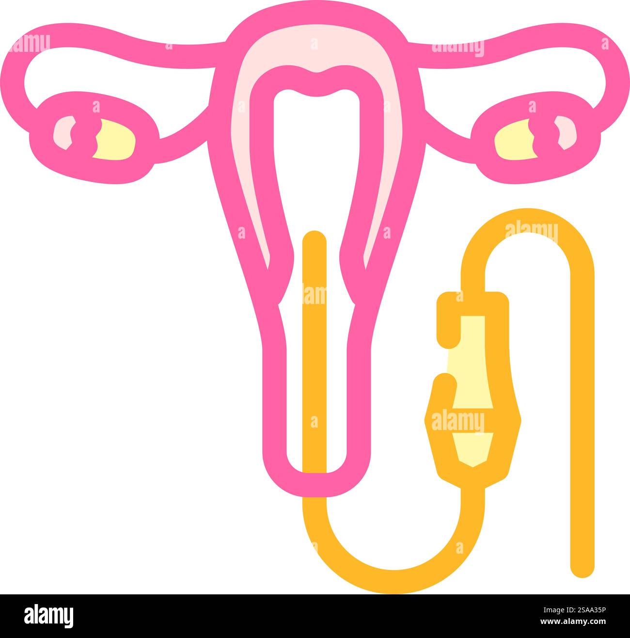 hysteroscopy surgery color icon vector. hysteroscopy surgery sign ...