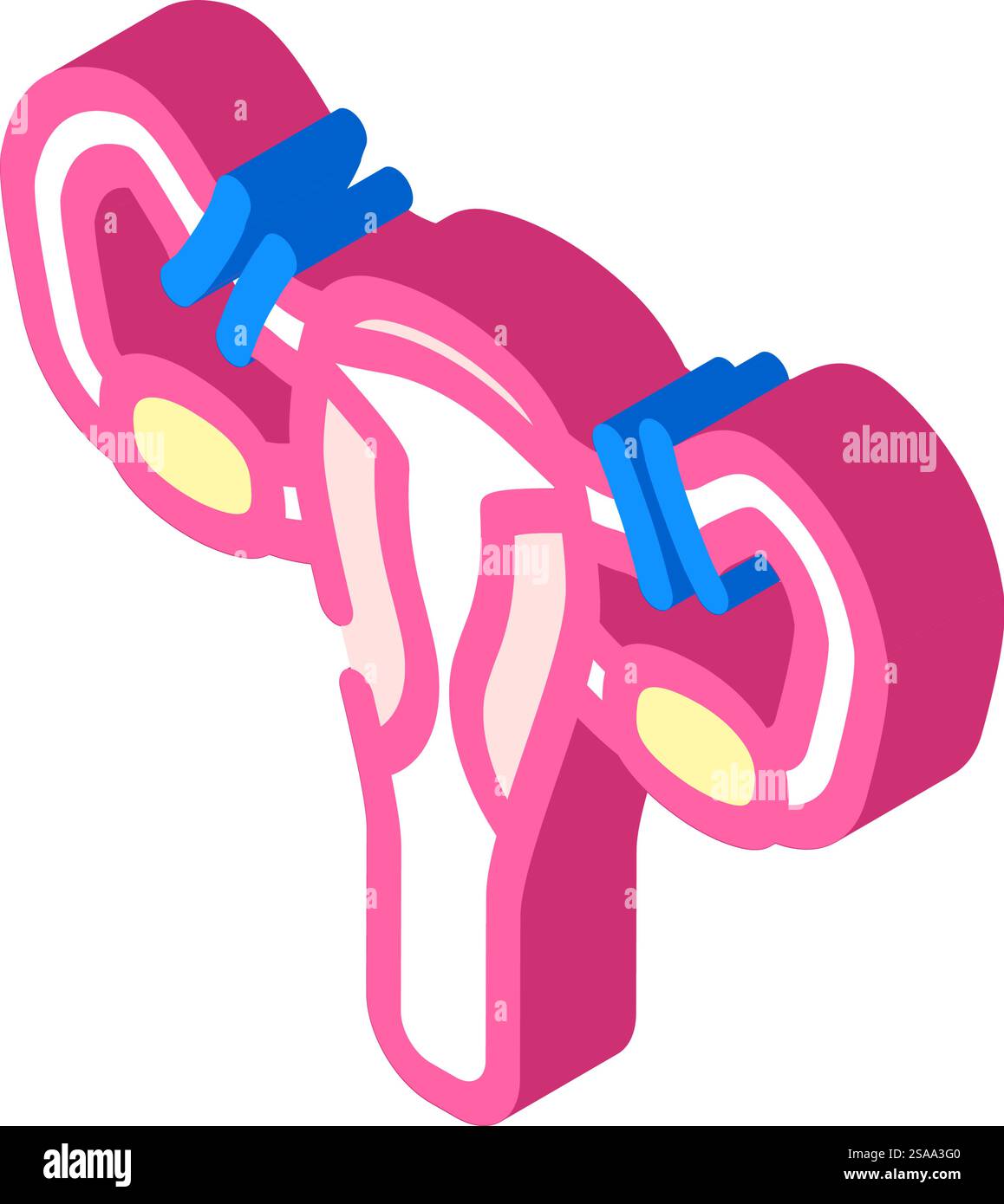 tubal ligation surgery isometric icon vector. tubal ligation surgery ...