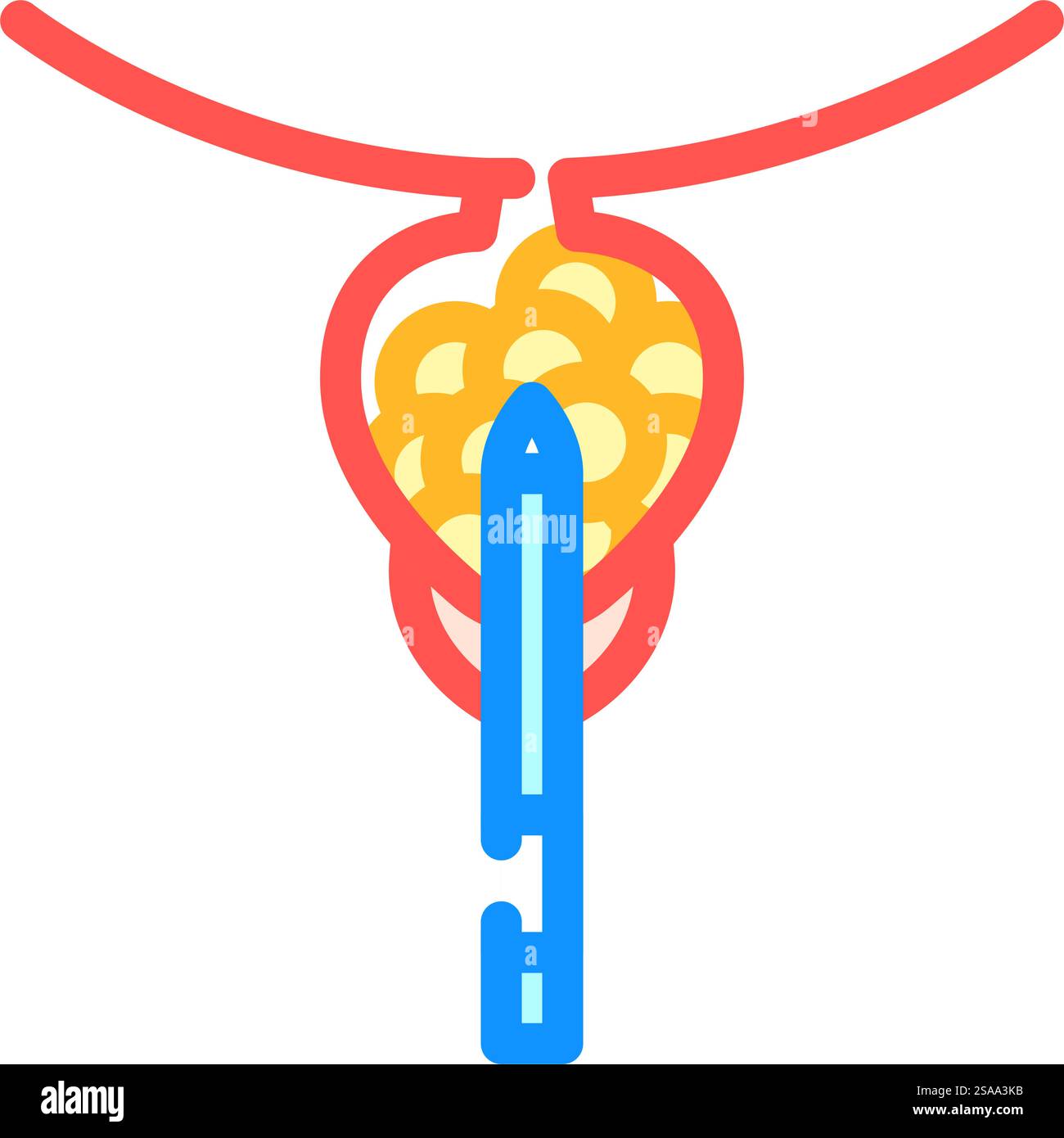 transurethral resection prostate surgery color icon vector ...