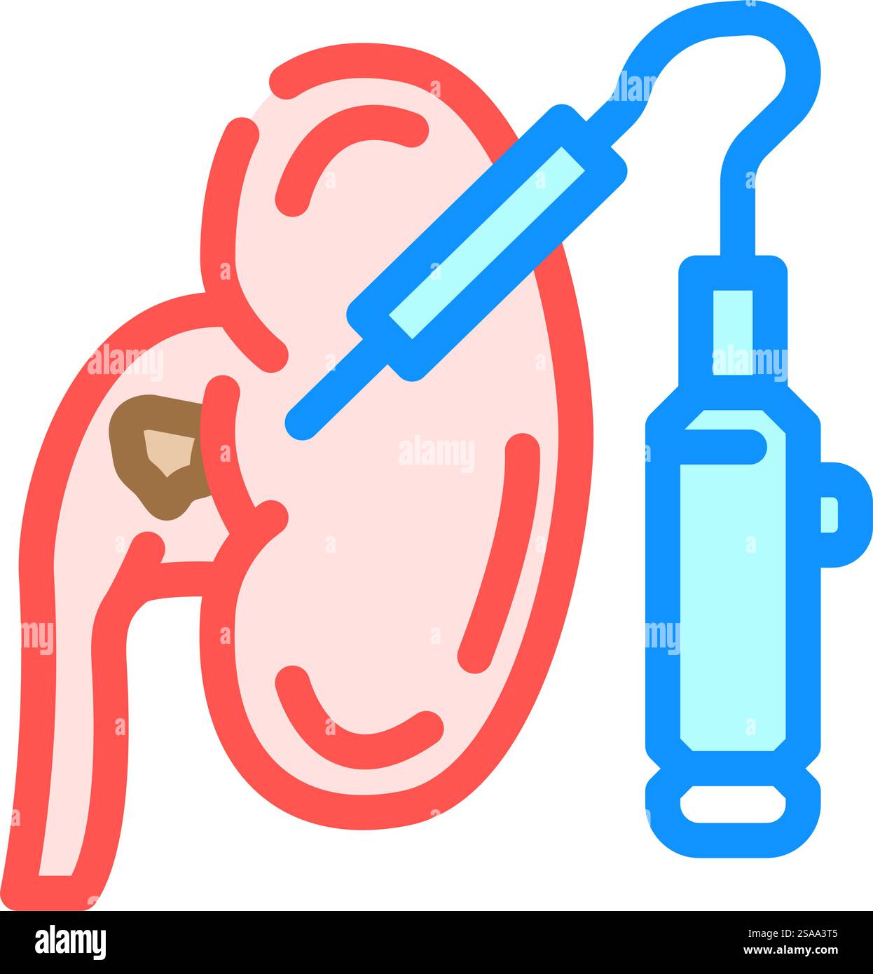Percutaneous nephrolithotomy Stock Vector Images - Alamy
