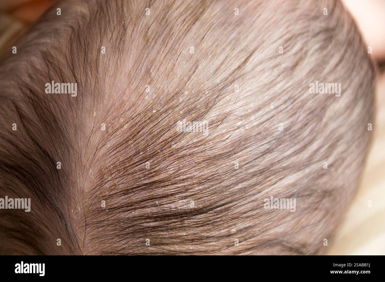 Newborn baby with psoriasis or dandruff in the hair Stock Photo - Alamy