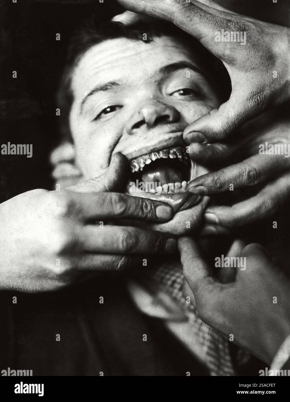 Friern Hospital, London: a boy with rotten teeth. Photograph, 1890/1910 ...