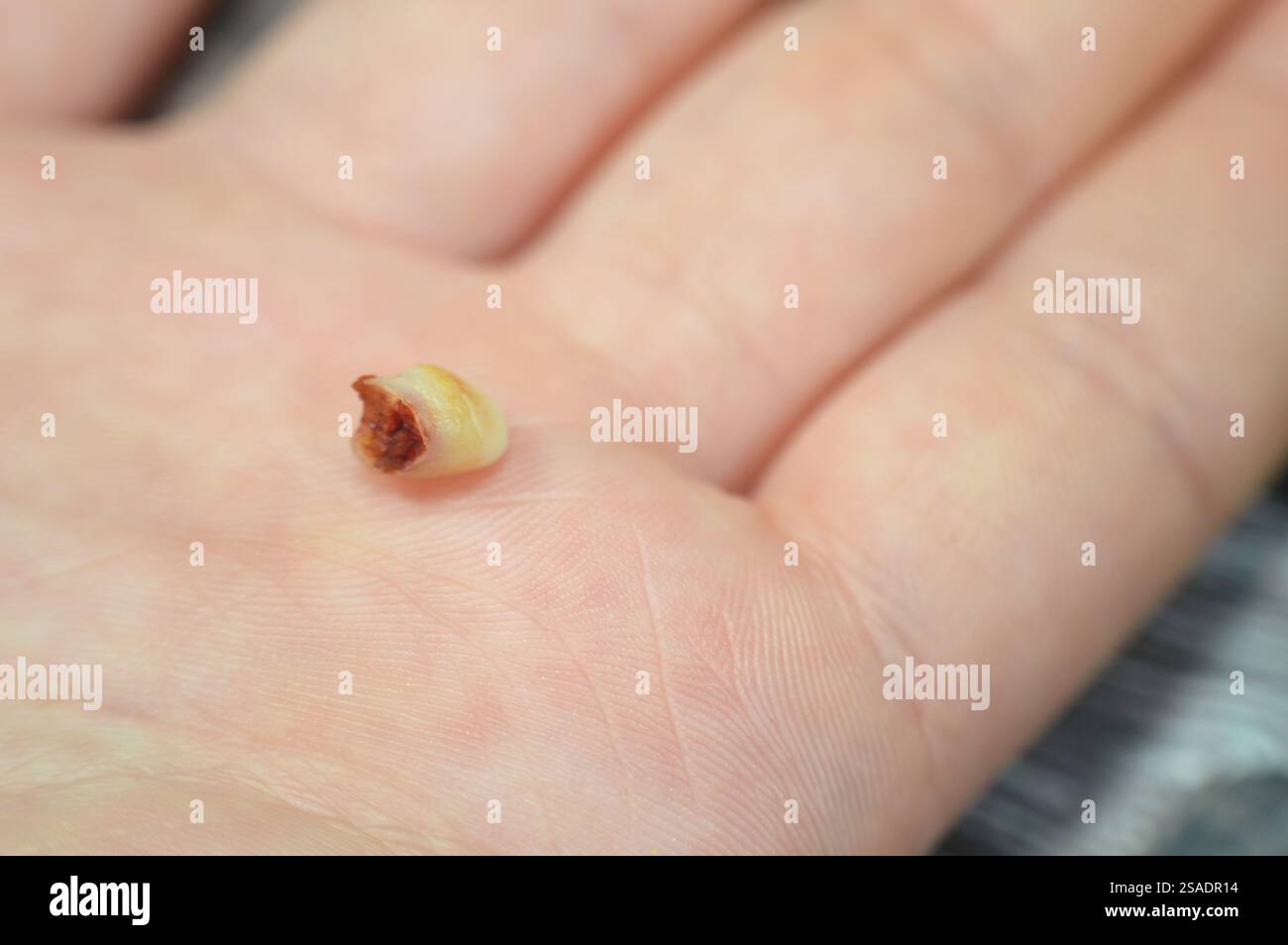Deciduous primary baby temporary tooth, the first set of teeth in the ...