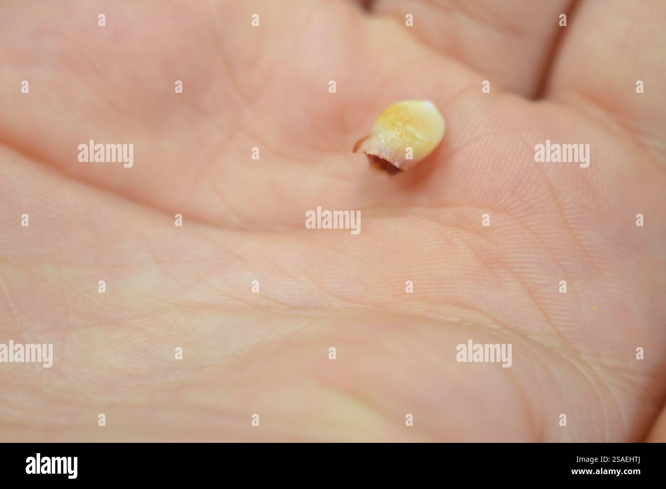 Deciduous primary baby temporary tooth, the first set of teeth in the ...
