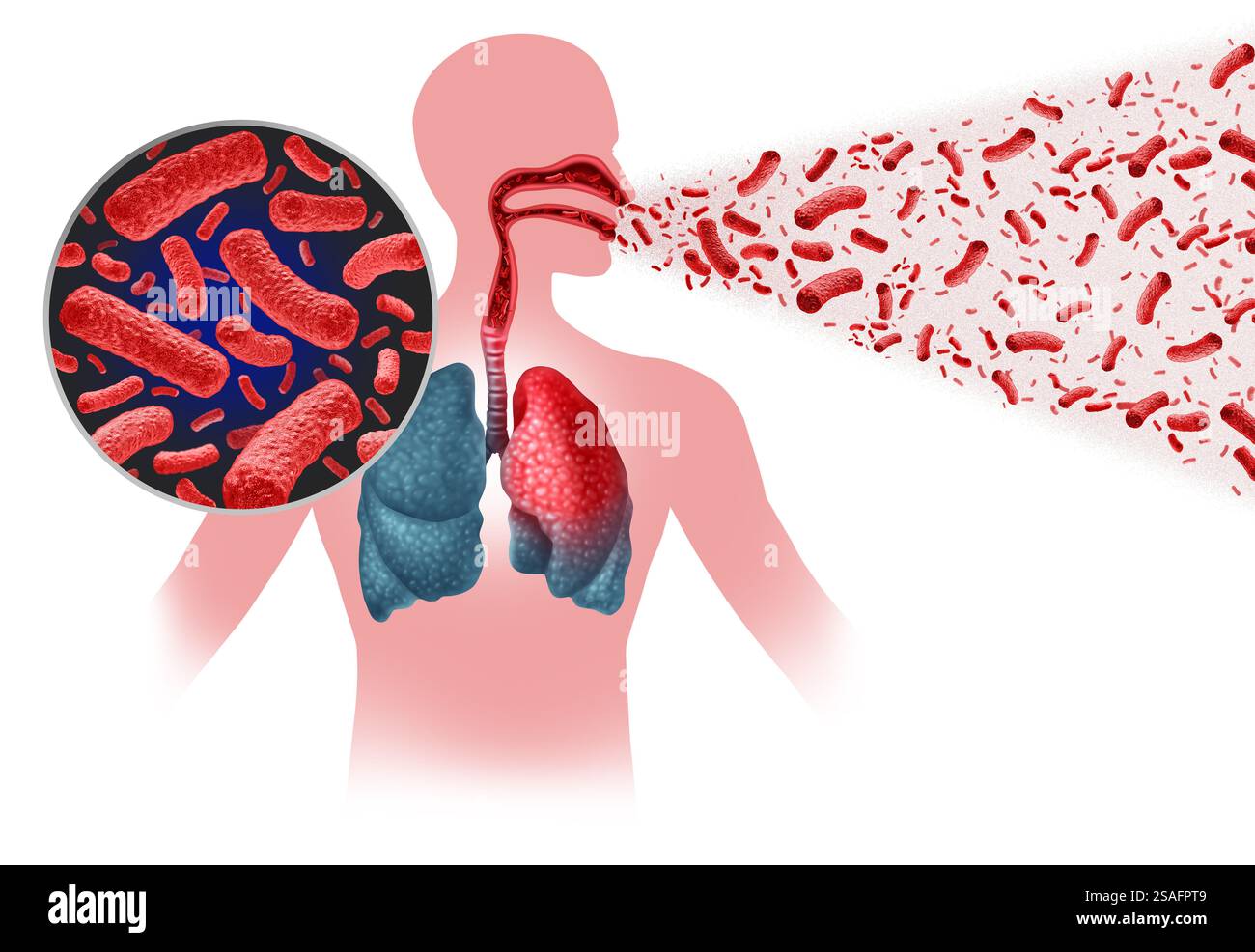 Tuberculosis infection Outbreak and TB transmission as a contagious ...