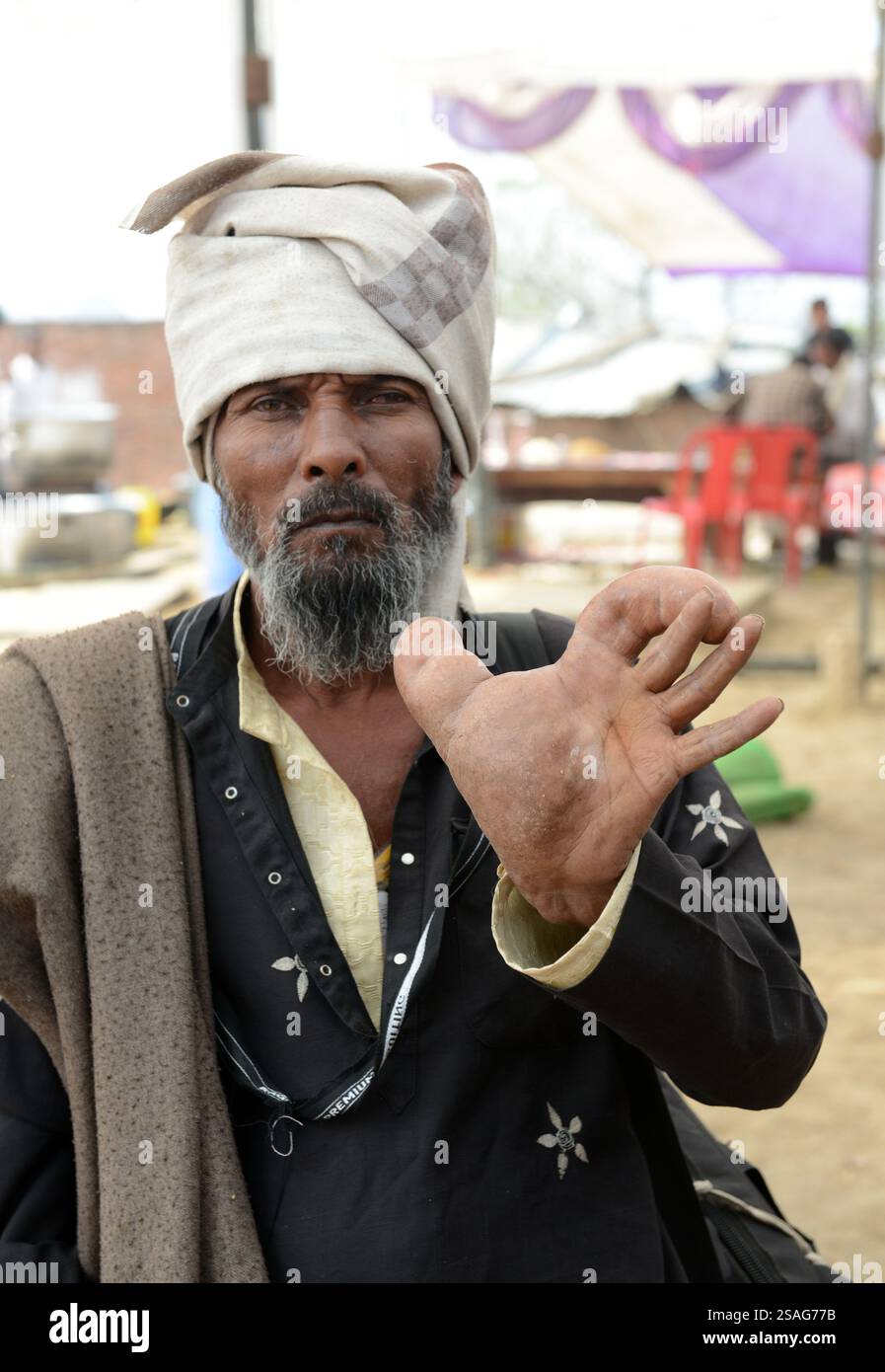 An Indian man suffering from Elephantiasis disease Stock Photo - Alamy