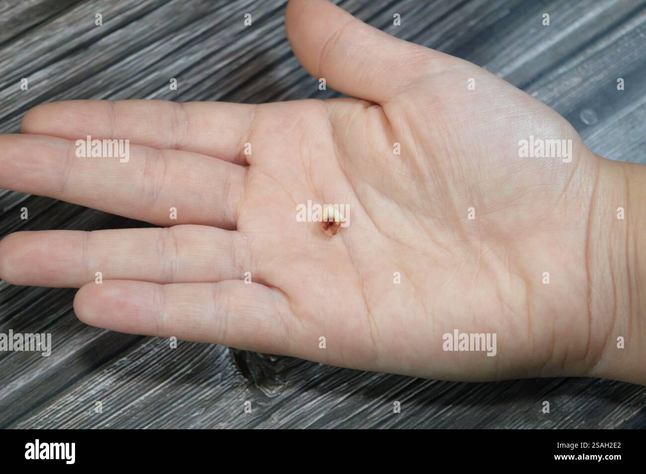 Deciduous primary baby temporary tooth, the first set of teeth in the ...