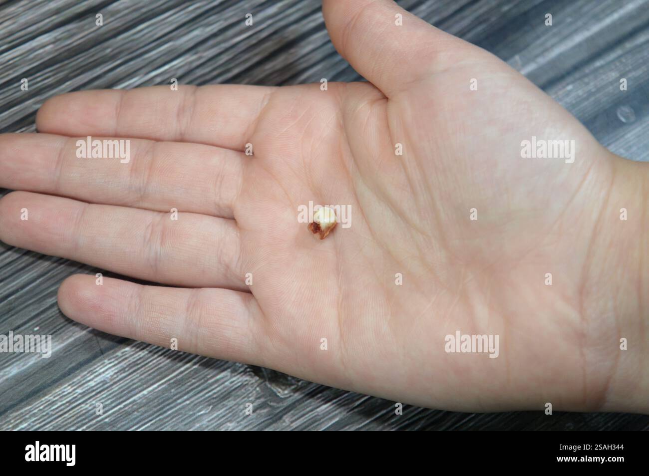 Deciduous primary baby temporary tooth, the first set of teeth in the ...