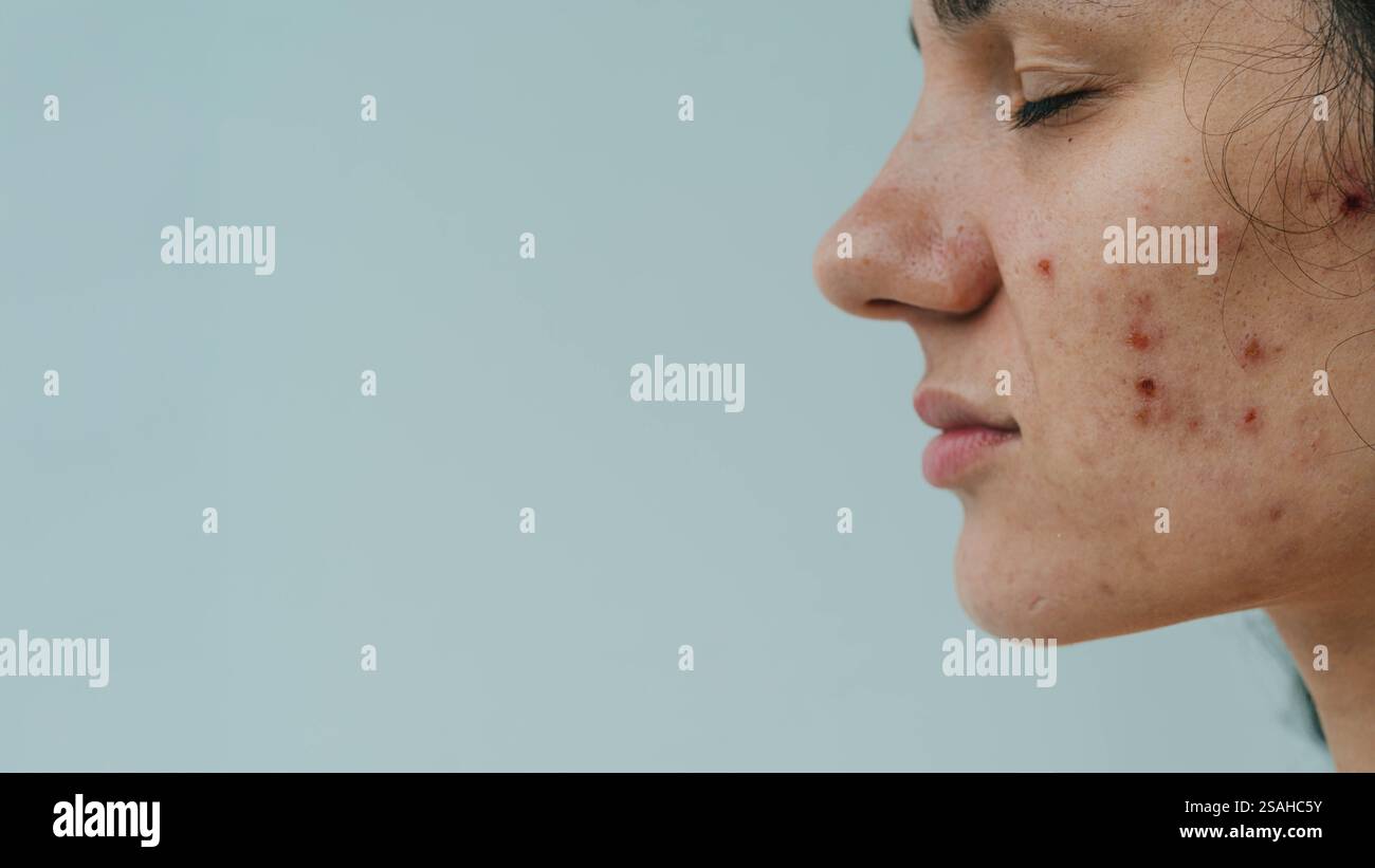 A large portrait of a young woman with skin problems - pimples, acne ...