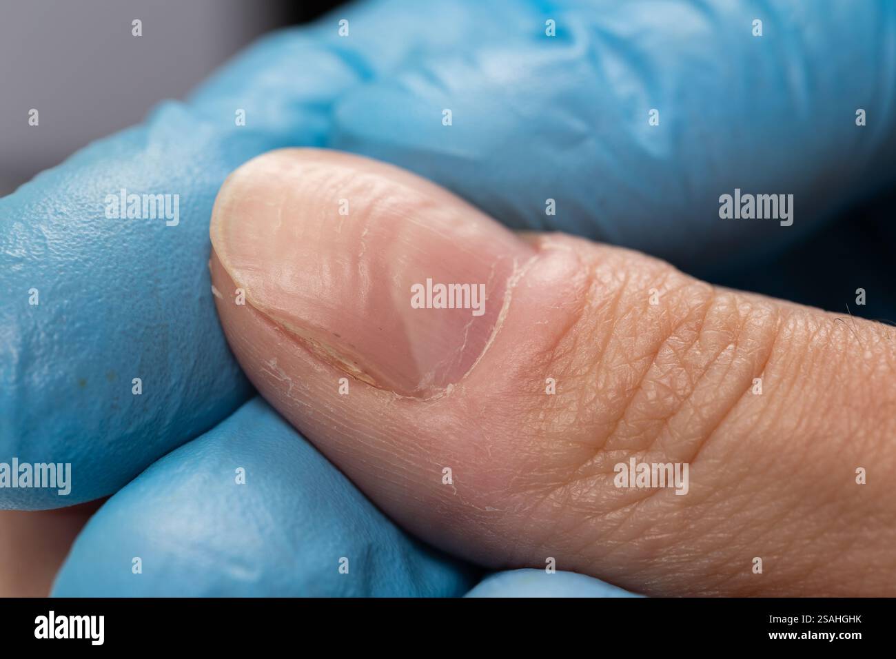 Doctor in gloves examining a ridged fingernails with vertical and ...