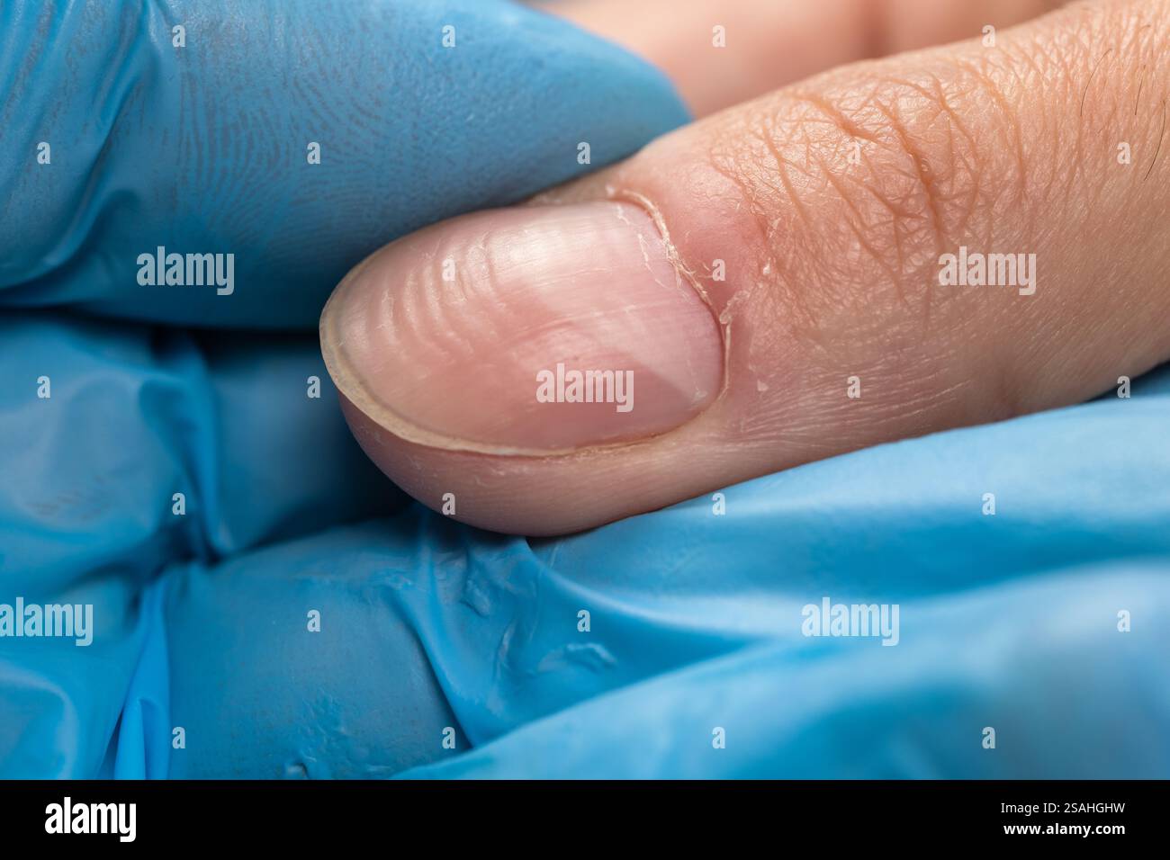 Doctor in gloves examining a ridged fingernails with vertical and ...