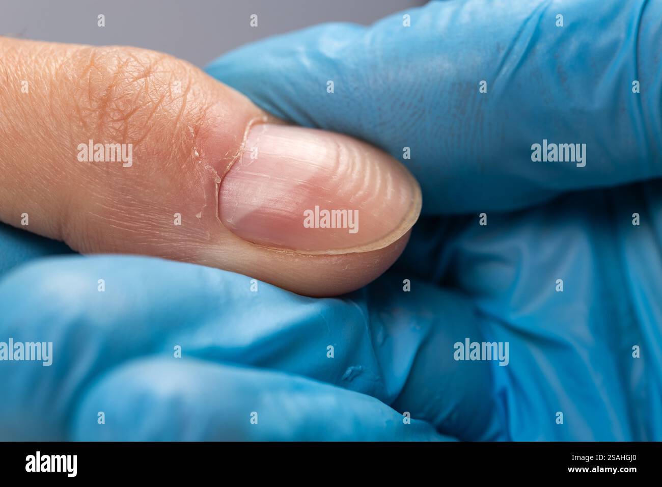 Doctor in gloves examining a ridged fingernails with vertical and ...