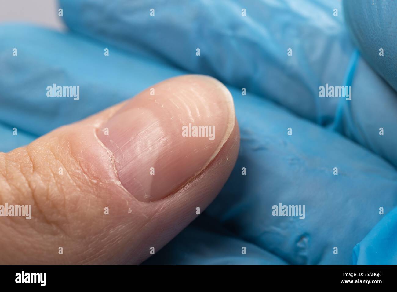 Doctor in gloves examining a ridged fingernails with vertical and ...