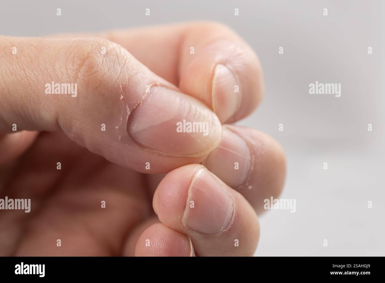 Ridged fingernails with vertical and horizontal ridges. Nails problems ...