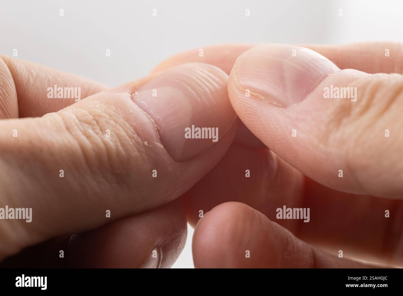 Ridged fingernails with vertical and horizontal ridges. Nails problems ...