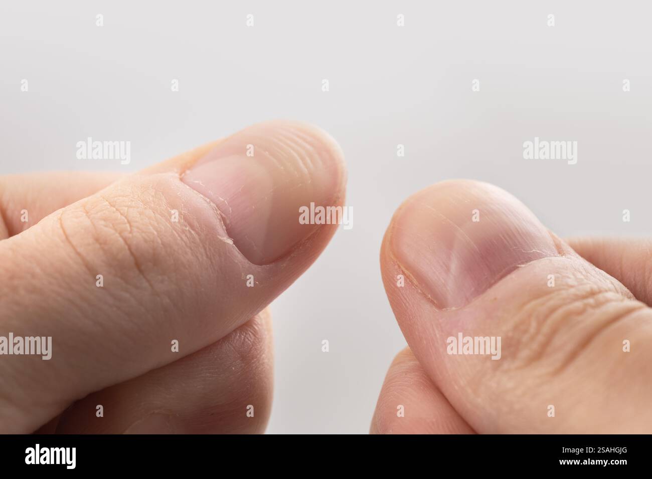 Ridged fingernails with vertical and horizontal ridges. Nails problems ...