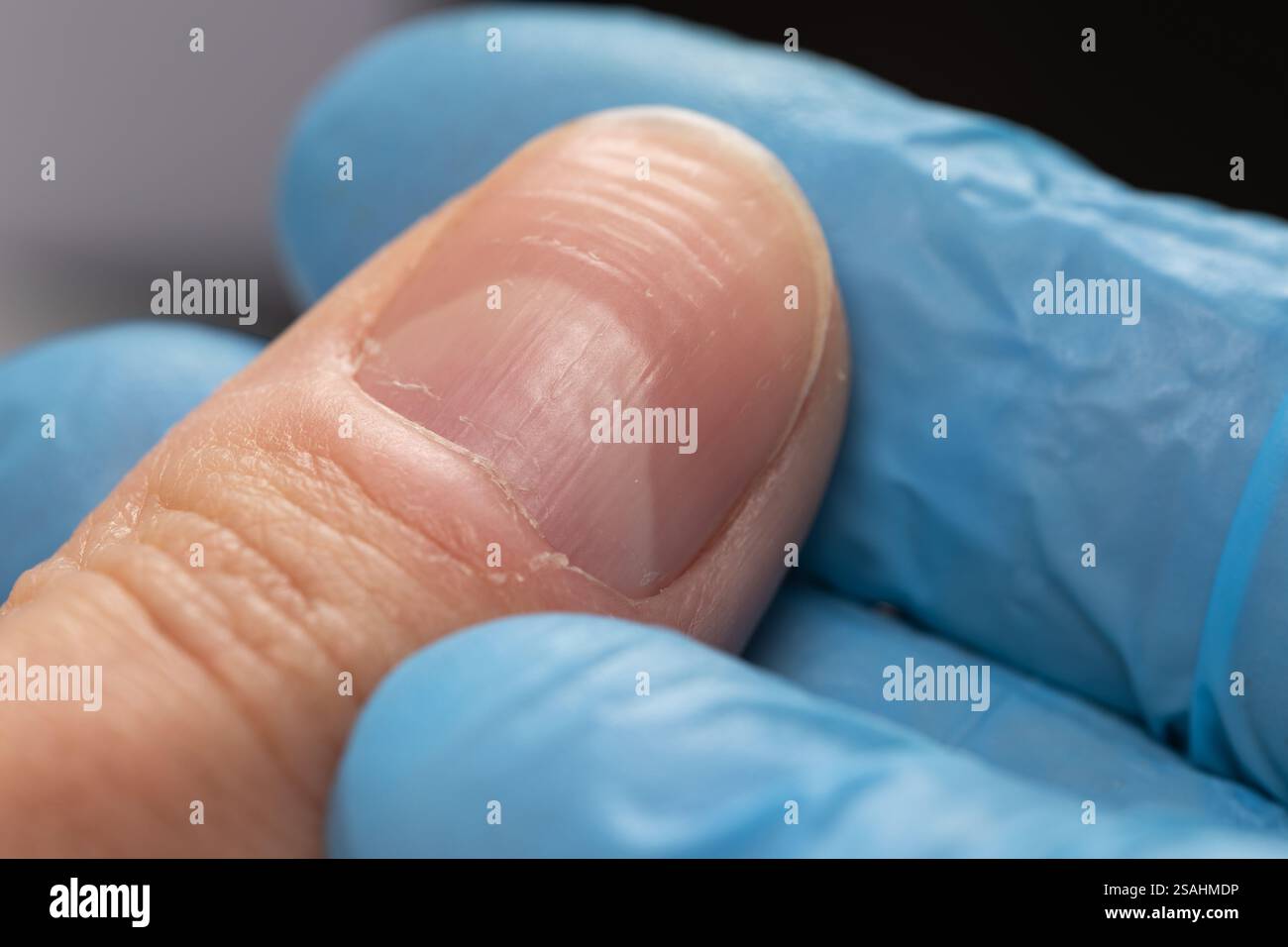 Doctor in gloves examining a ridged fingernails with vertical and ...