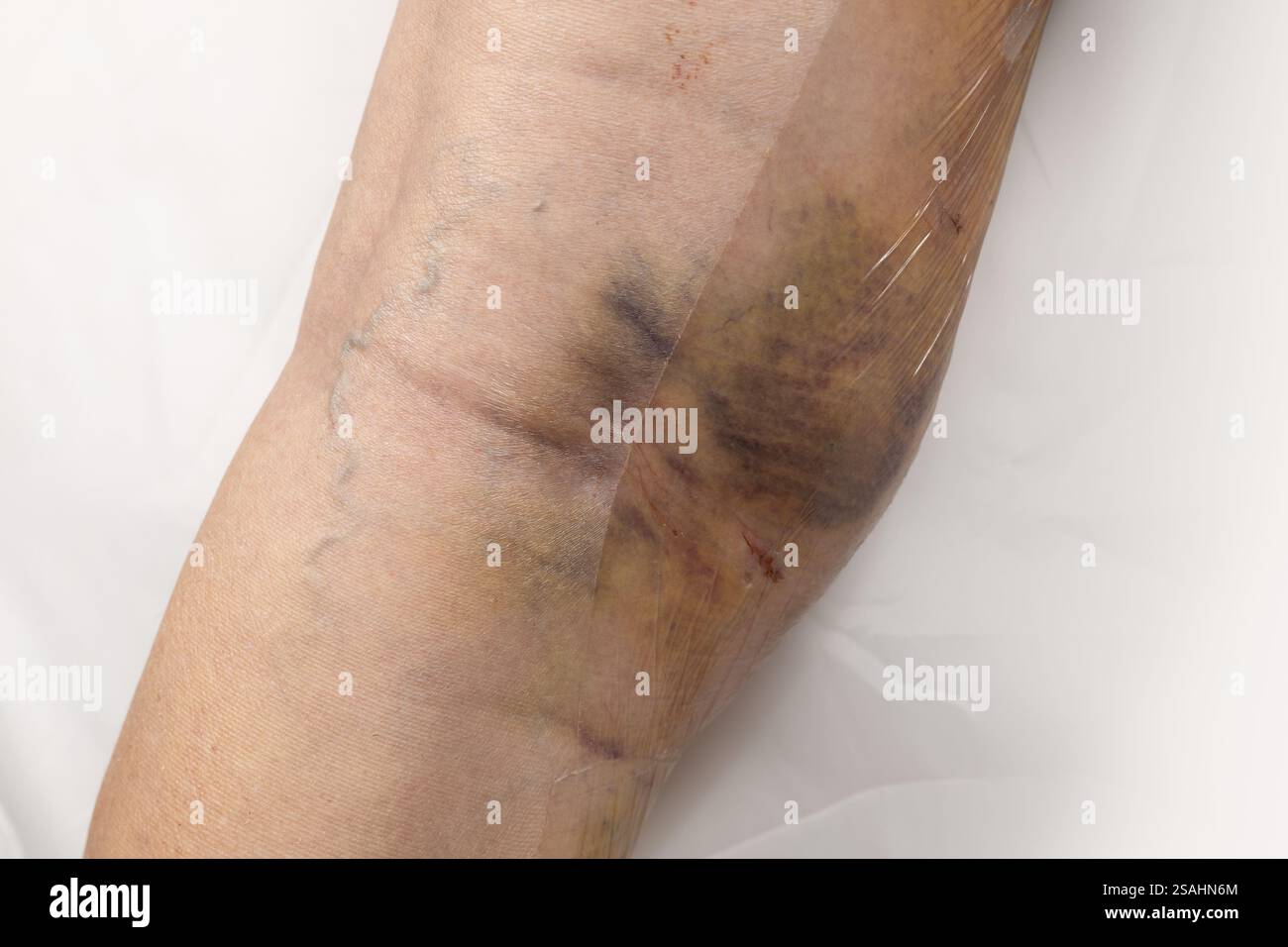 Scars on the lower leg of a woman after varicose vein. Hematomas from ...
